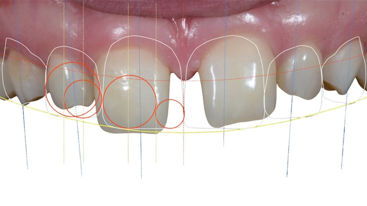 Smile Makeover and Smile Designing - DR GUL'S DENTAL CLINIC NOIDA