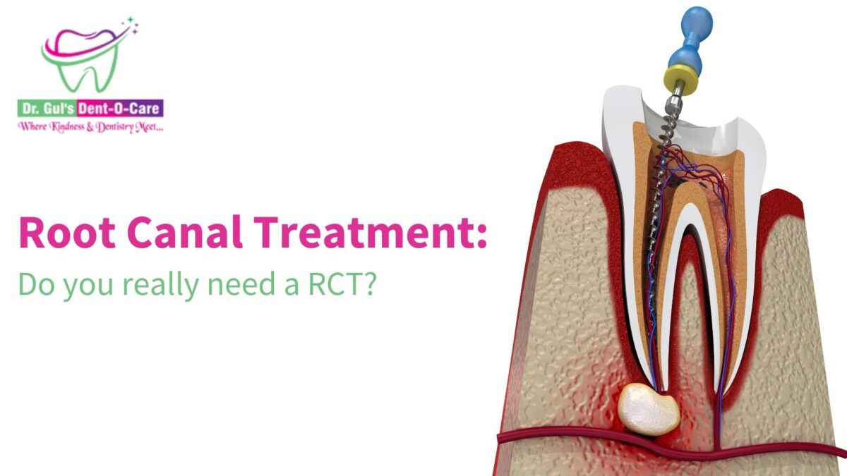 Do you really need a Root Canal, RCT: when it needed?