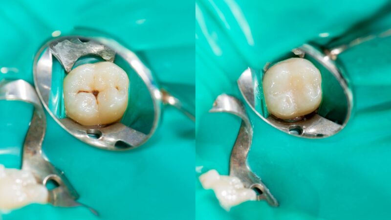 Tooth Colored Filling In Noida - DR GUL'S DENTAL CLINIC NOIDA