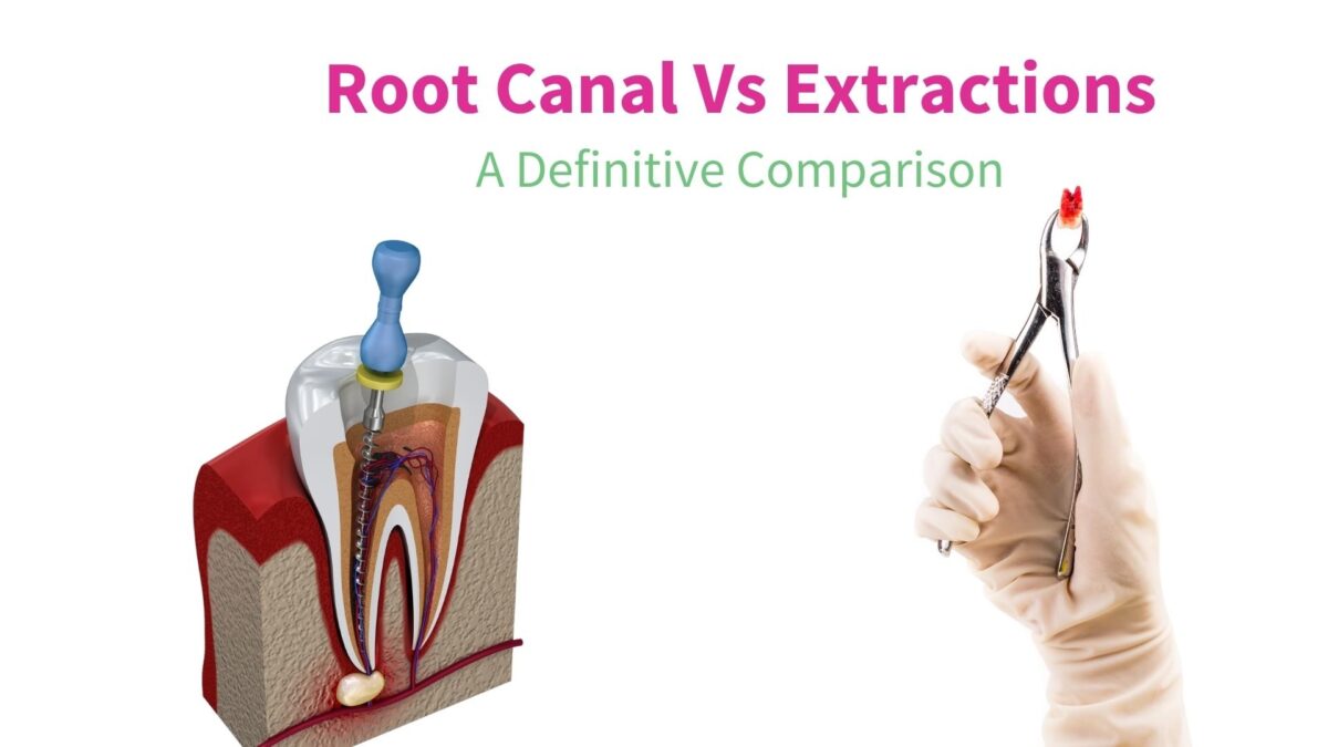 Root Canal vs Extraction: Which Option is Best for You & the ...