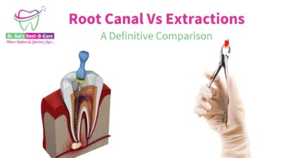 Root Canal vs Extraction: Which Option is Best for You & the Complications